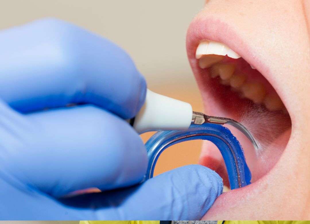 La profilaxis dental y sus beneficios para tu salud bucodental ...